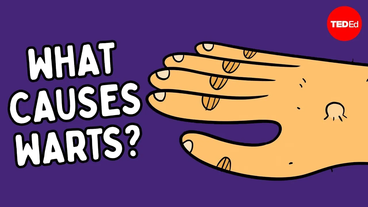 What Are Warts And How Do You Get Rid Of Them - ClassX